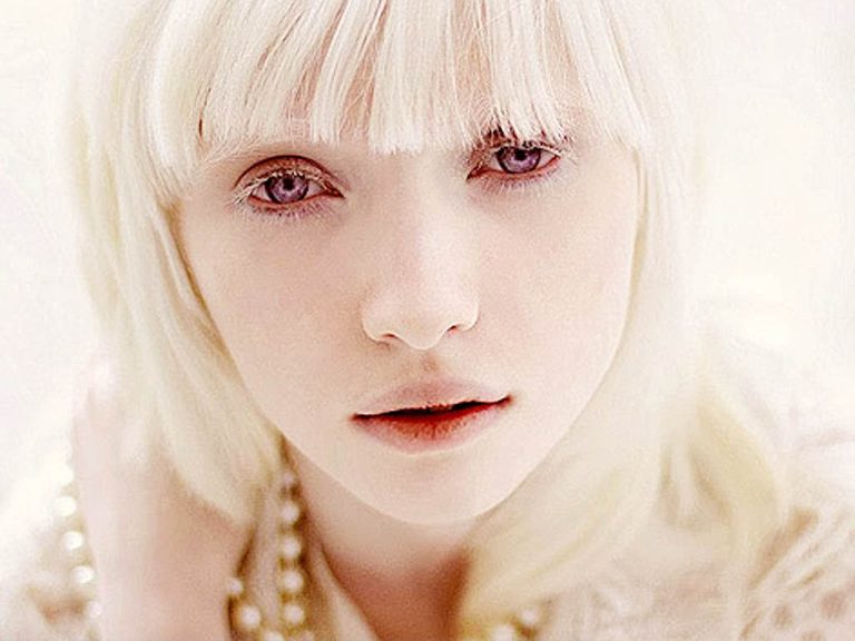 Albinisme: Kondisi Genetik Kulit dan Mata Terlihat Unik ...